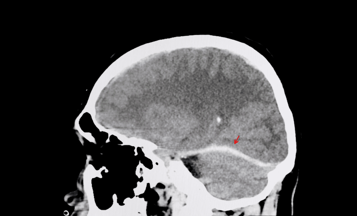The Early Signs of Traumatic Brain Injury